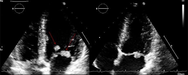 Cas clinique : Végétations sur la valve mitrale après un AVC