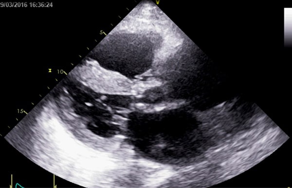 Cas clinique: une insuffisance cardiaque particulière