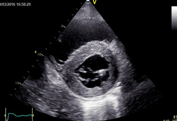 Cas clinique: une insuffisance cardiaque particulière