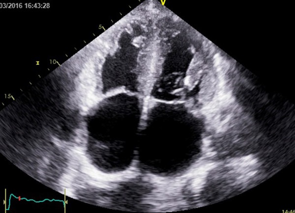 Cas clinique: une insuffisance cardiaque particulière