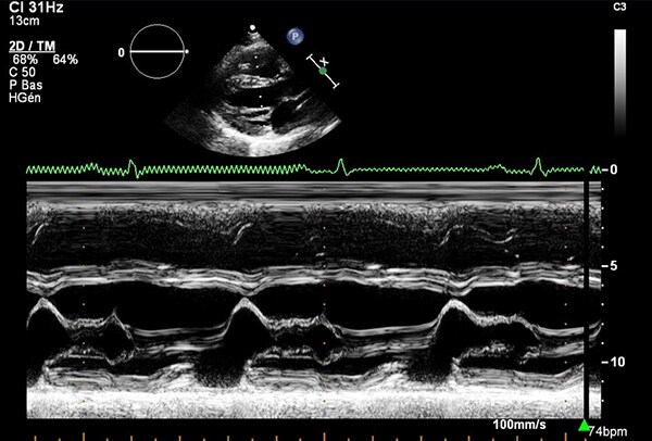 Cas clinique: calcifications intra-cardiaques chez une jeune femme ...