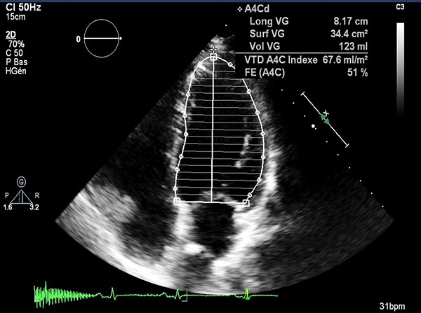 Cas clinique: calcifications intra-cardiaques chez une jeune femme ...