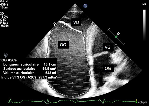 Cas clinique: jeune homme asymptomatique sous anti-arythmiques