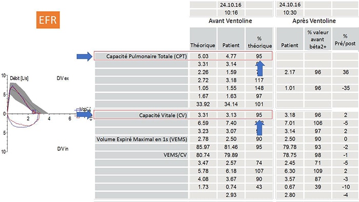 Cas clinique: épisodes de dyspnée sifflante et de bronchites à ...