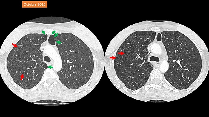 Cas clinique: épisodes de dyspnée sifflante et de bronchites à ...