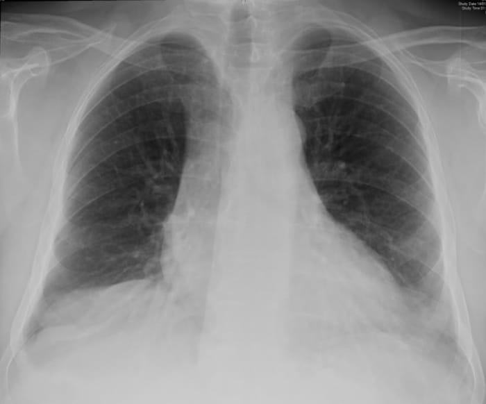 Cas clinique: patient avec douleur subaigüe rétrosternale avec ...