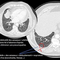 Cas clinique: patient avec douleur subaigüe rétrosternale avec ...