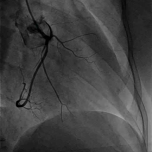Cas clinique : douleur thoracique avec dilatation du ventricule droit