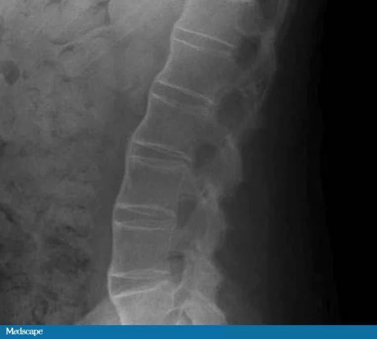 Cas clinique : douleurs et raideur au bas du dos chez un patient de 26 ans
