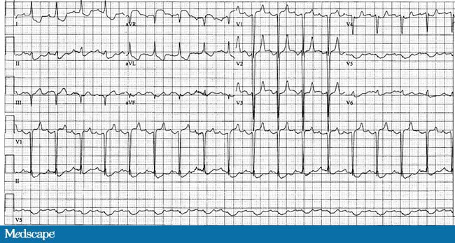 Que signifient ces ondes T sur cet ECG