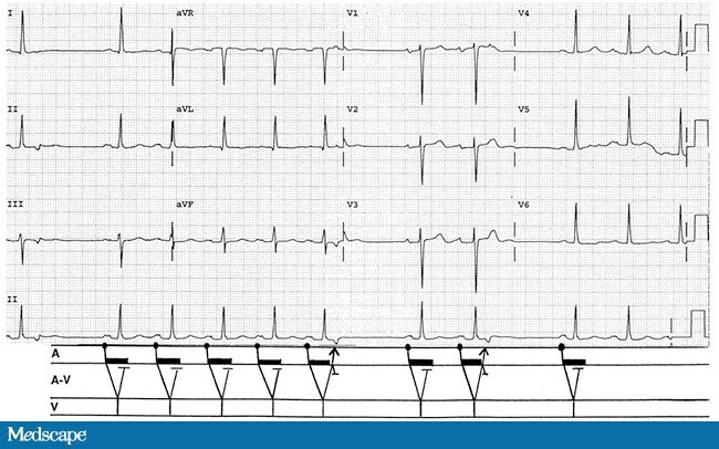 Comment expliquez-vous ces pauses sur cet ECG ? - Page 2