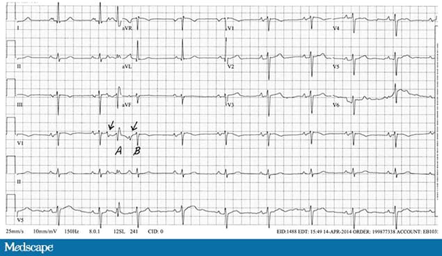 ECG : Pourquoi une seule des extrasystoles atriales a-t-elle une ...