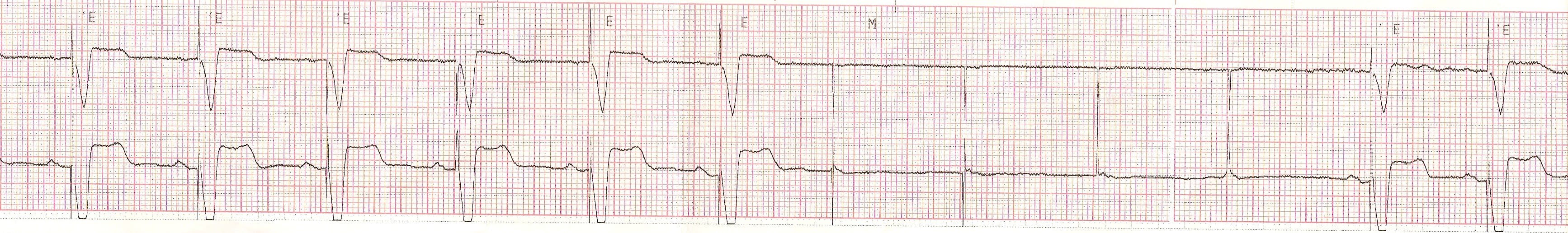 ECG : Pourquoi une pause ventriculaire après ce changement de pacemaker