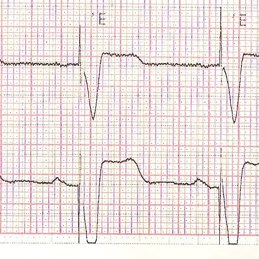 ECG : Pourquoi une pause ventriculaire après ce changement de pacemaker