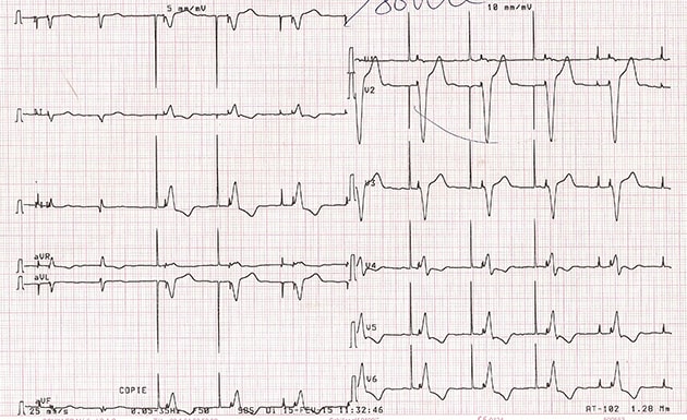 ECG: Que pensez-vous de ce rythme électro-entraîné?