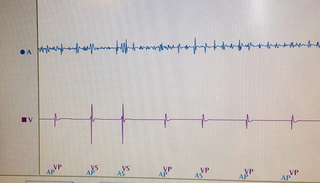 ECG: Que pensez-vous de ce rythme électro-entraîné? - Page 2
