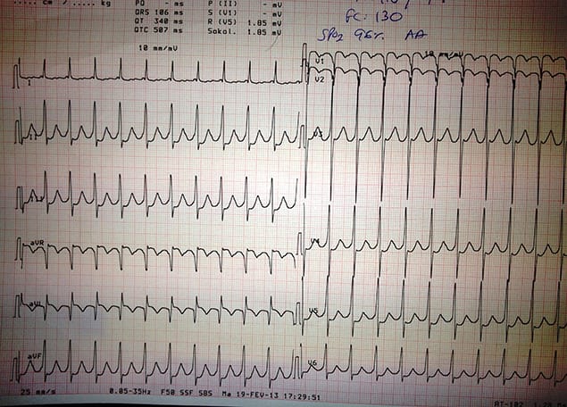 ECG : À quoi correspond cette tachycardie à QRS fins?