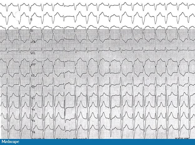 ECG : Cardiomyopathie dilatée