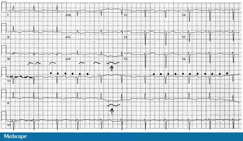 ECG: Quelle est cette ondulation ? - Page 2