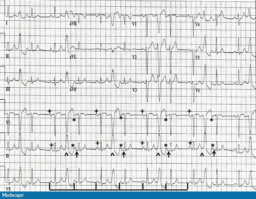 ECG : Rythme sinusal, mais quoi d'autre ? - Page 2