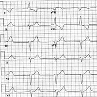 ECG : Quel est le rythme post-stent