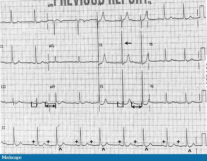 ECG : une rotation antihoraire - Page 2