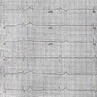 ECG : « J'ai l'impression de perdre connaissance