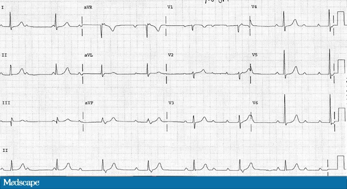 ECG : pourquoi le pouls est-il si lent