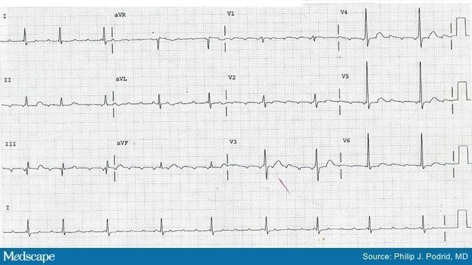 ECG : rythme irrégulier lors d’un examen de routine