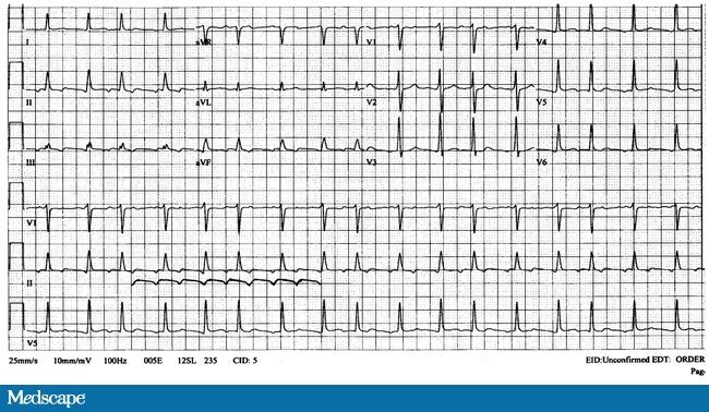 Quel est le rythme sur cet ECG ? - Page 2