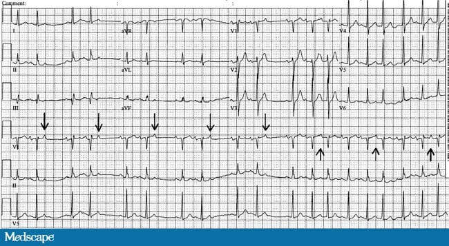 Quelle anomalie survient sur cet ECG