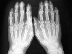 Quiz express : la polyarthrite rhumatoïde