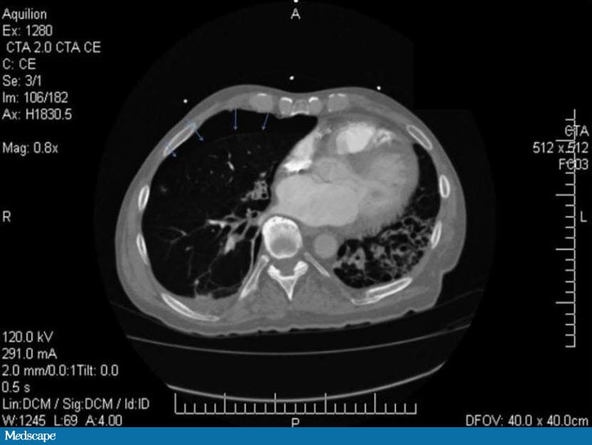 L'essentiel en pneumologie – 2012 | Medscape