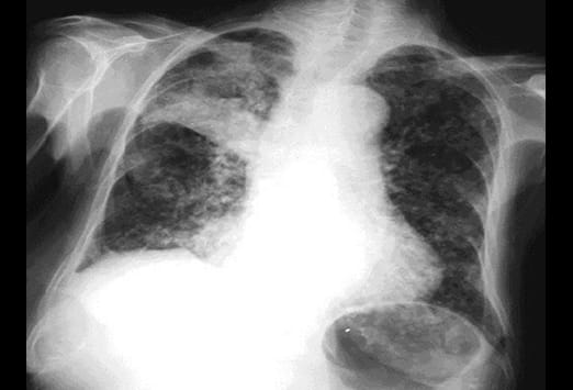 Tuberculose : focus sur l’imagerie et les traitements | Medscape