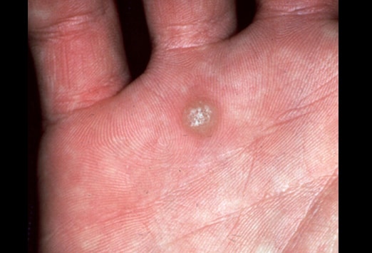 Savez-vous différentier les lésions cutanées bénignes des cancers de la ...