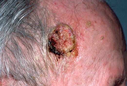 Savez-vous différentier les lésions cutanées bénignes des cancers de la ...