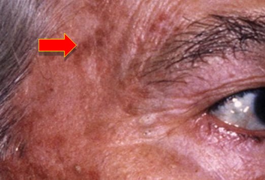 Savez-vous différentier les lésions cutanées bénignes des cancers de la ...