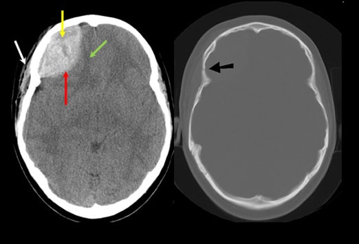 Diaporama : le scanner cérébral sans injection | Medscape