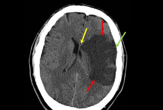Diaporama : le scanner cérébral sans injection | Medscape