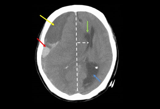 Diaporama : le scanner cérébral sans injection | Medscape