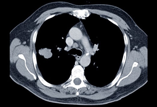 Cancer du poumon : présentations cliniques | Medscape
