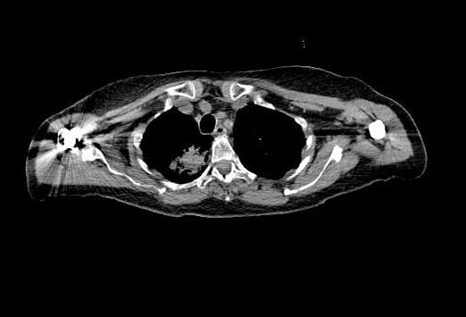 Cancer du poumon : présentations cliniques | Medscape