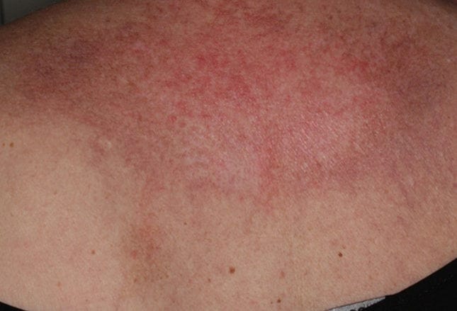 Reconnaître les affections cutanées associées aux maladies rhumatismales