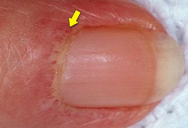 Reconnaître les affections cutanées associées aux maladies rhumatismales