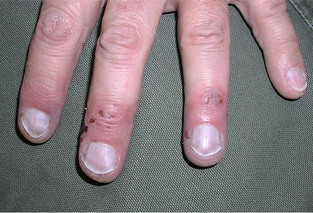 Affections non arthrosiques des mains: Faites votre diagnostic