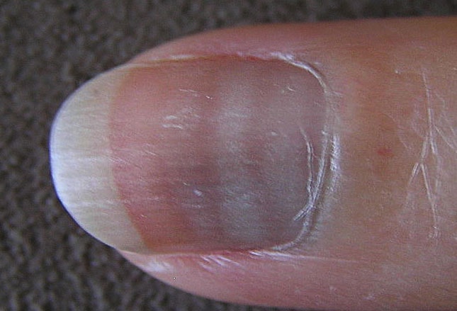 Manifestations cutanées des empoisonnements : 10 cas cliniques