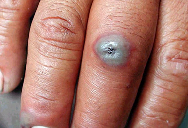 Manifestations cutanées des empoisonnements : 10 cas cliniques