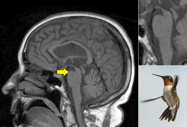 Maladie de Parkinson : bien plus qu’une maladie motrice