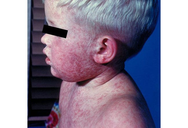 Manifestations cutanéo-muqueuses des infections virales