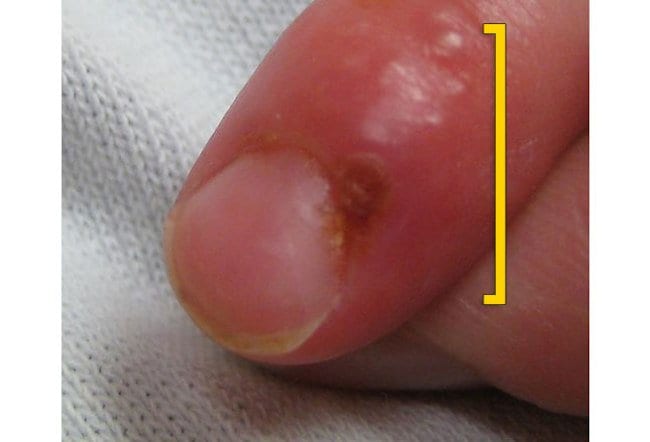 Manifestations cutanéo-muqueuses des infections virales